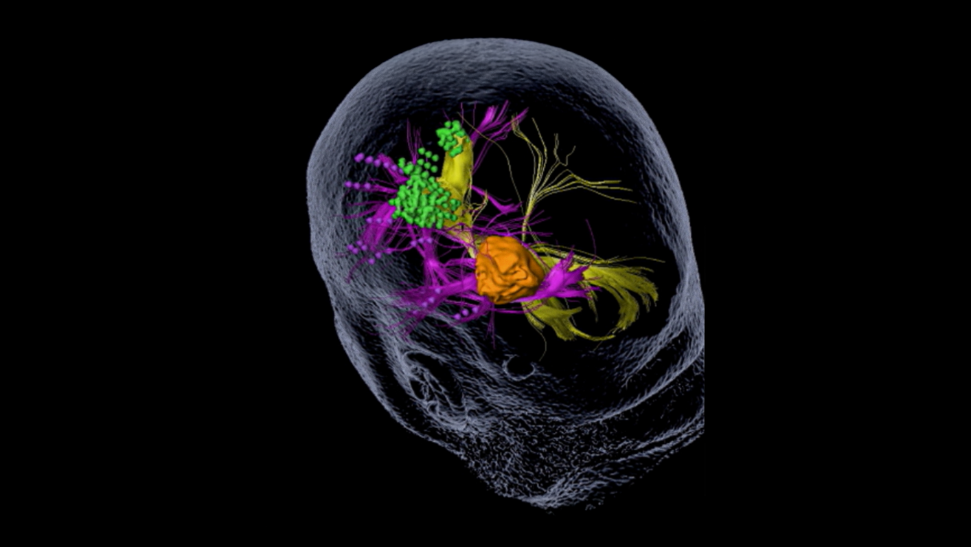 Nexstim Ntms And Brainlab Elements Brainlab